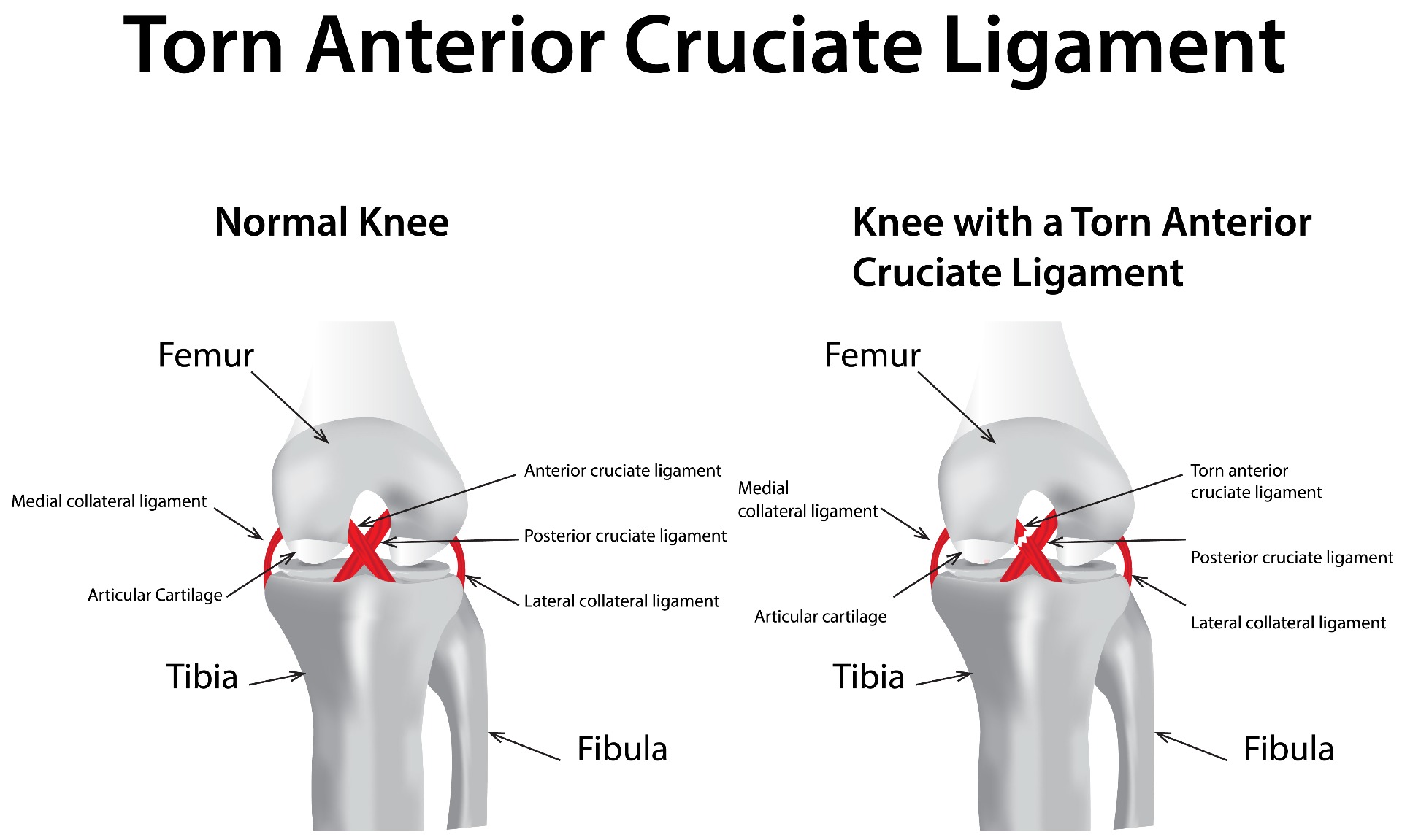 What Football Players Need To Know About Acl Injuries Performance What Football Players Need To Know About Acl Injuries Performance